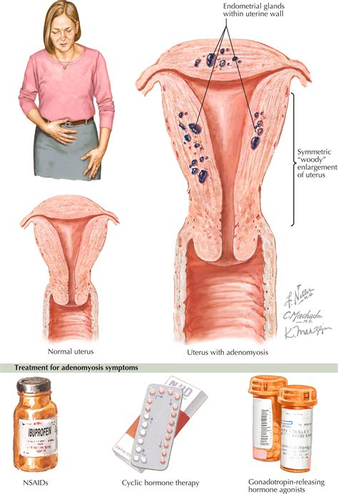 Adenomyosis Clinical Tree
