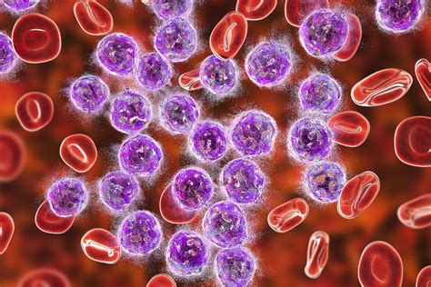 Zanubrutinib Improves Pfs Vs Bendamustine Combo In Cll Sll Subgroups