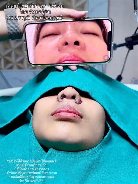หทัยทิพย์คลีนิก ศัลยกรรมความงาม สาขาพระราม2 🎉โปรโมชั่น ️ตัดปีกจมูก 5990 ค่ายา 1000 จบราคานี้
