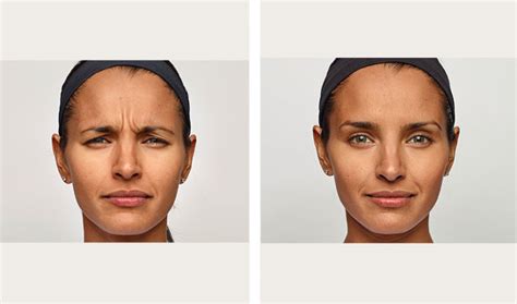 Botox Nyc New York City Botox Injections Dr Thomas Loeb
