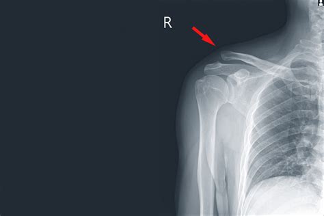 Assessment Of Acromioclavicular Joint Injuries Physio Network