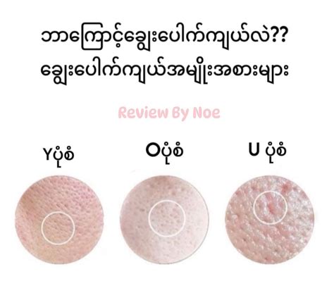 Review ချွေးပေါက်ကျယ်အမျိုးအစားများနဲ့ ဘာကြောင့်ချွေးပေါက်ကျယ်ရသလဲ ဘယ