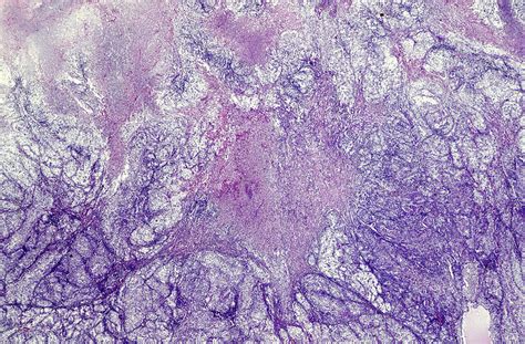 Endodermal Sinus Tumour Light Micrograph Stock Image C049 8822 Science Photo Library