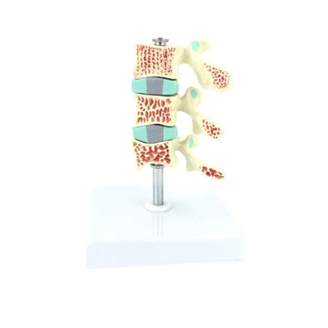 Buy Osteoporosis Model 3 Vertebrae Anatomy Human Skeleton