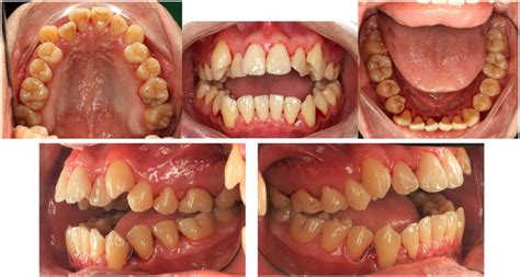 Pretreatment Intra Oral Pictures Download Scientific Diagram