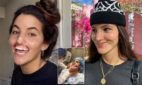 Model 23 Whose Upper Lip Was Torn Off By A Pit Bull Shows Off Her New
