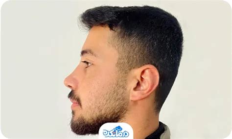 عمل بینی عروسکی؛ از معرفی انواع عمل تا مراقبت‌های بعد از آن