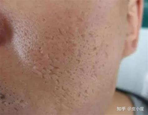 脸上毛孔粗大有黑头怎么解决？ 知乎