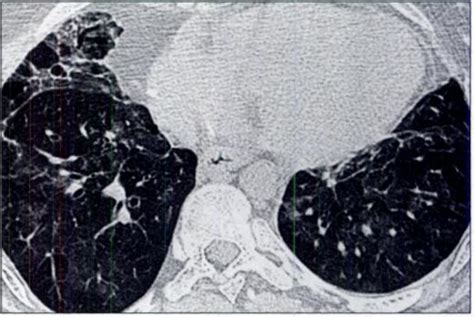 Bronchiolitis Obliterans Syndrome In 19 Year Old Woman Who Had
