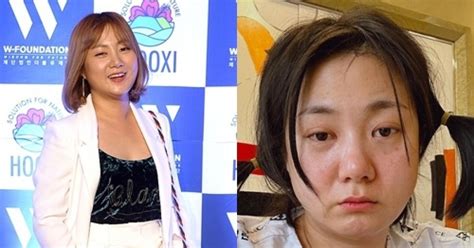 박나래 성대 수술 후 홀쭉해진 얼굴로 “잠깐 고치는 중 지금은 퇴원” 전문