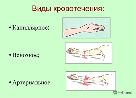 Презентация на тему Способы остановки кровотечения Правила наложения