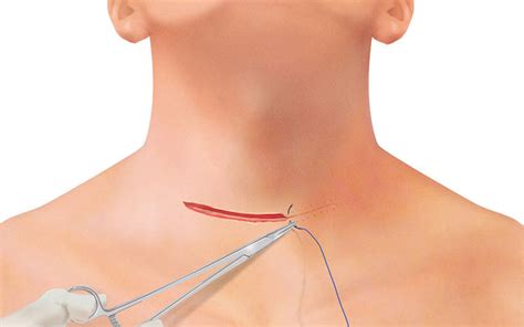 Thyroidectomy Procedure Guide Thunderbeat™ Open Fine Jaw Olympus Professional Education On