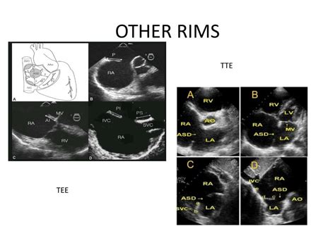 Ppt Echo Assessment Of Atrial Septal Defect Powerpoint Presentation