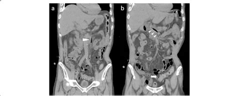 Nonenhanced Ct At Admission Showed Extensive Thrombophlebitis Of The