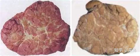 胸腺肿瘤的病理和影像学诊断胸腺瘤篇 知乎