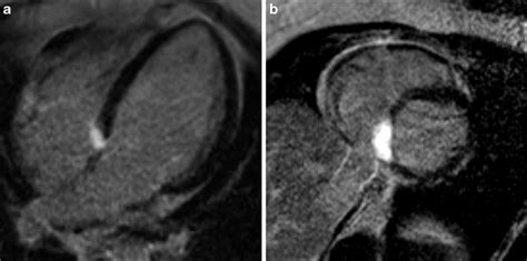 Lge Cmr Images Showing Basal Inferoseptal Fibroma In A 4 Chamber View Download Scientific