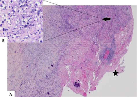 The Brief Case A Mixed Cutibacterium Species Positive Valve Culture