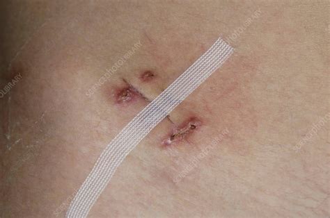 Infected Appendectomy Wound Stock Image C0042475 Science Photo