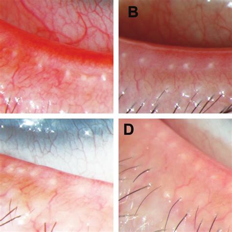 Clinical Features Of Meibomian Gland Dysfunction Notes Eyelid Margin