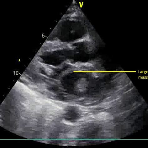 Large Cystic Mass In La Download Scientific Diagram