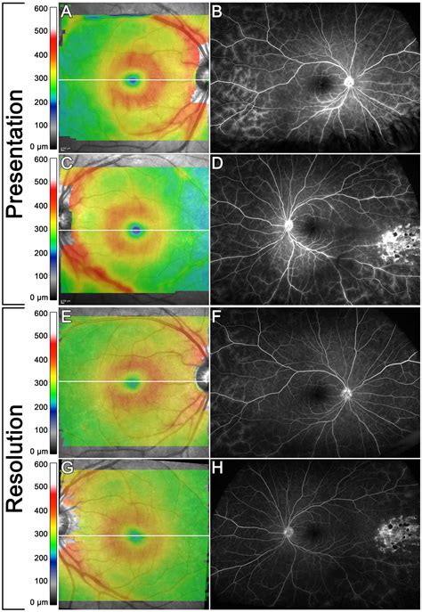 Retinal Vasculitis Eye Anti Tubercular Therapy Alone For Treatment Of