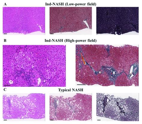 Histopathological Differences Between Ind NASH And Typical NASH Download Scientific Diagram