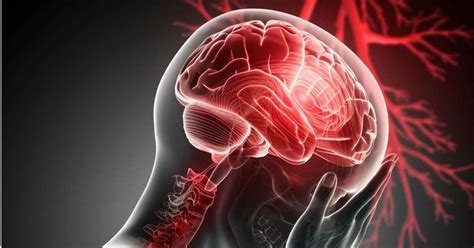 Symptoms Of Brain Bleed After A Head Injury Herbert Trial Law