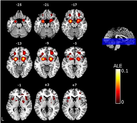 Localization Of Signi Fi Cant Ale Values Superimposed On A Standard Download Scientific Diagram