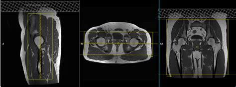 Mri Arthrogram Hip Protocol And Planning Indications For Mri Arthrogram Hip Scan