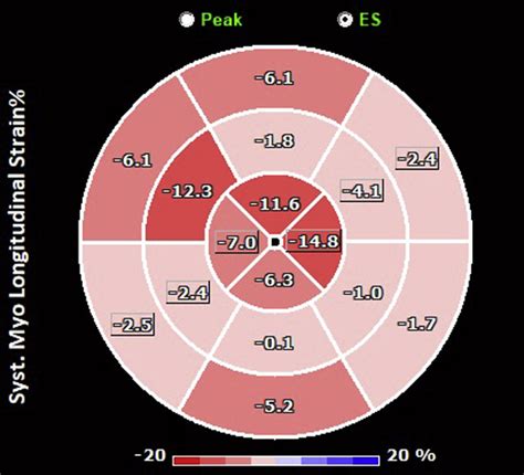 An Autopsy Case Of Cardiac Amyloidosis With Heterogeneous Deposition Of Amyloid Protein A