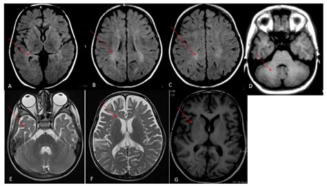 Brain Mri Of 2 Patients With Late Infantile Onset Npc A F A C