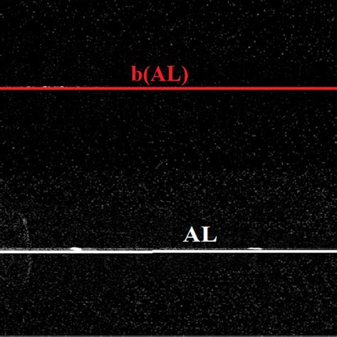Measurement Of Anterior Segment Parameters Via Ss Oct Images Located At