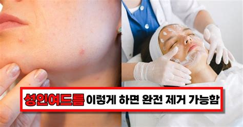 성인여드름 나는 원인 알고 해결했어요” 피부과 원장이 알려주는 성인 여드름 해결방법 라임뉴스