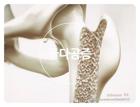 골다공증 원인 5가지 증상 치료 검사수치 주사요법 골다공증에 좋은 음식 네이버 블로그