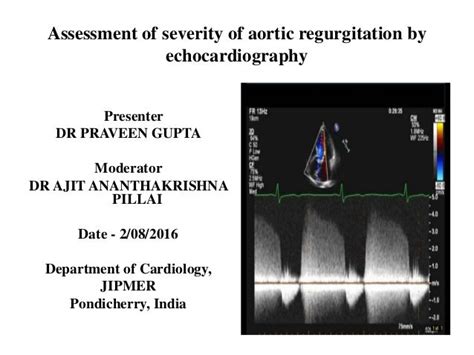 Echocardiography Assessment Of Aortic Regurgitation Severity