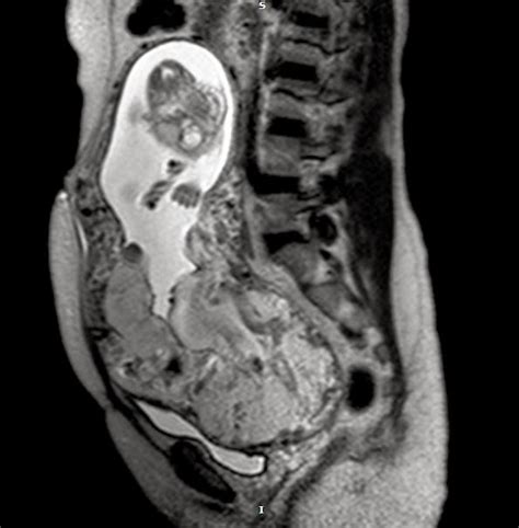 Placenta Increta Mri Sumers Radiology Blog