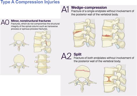 Thoracolumbar Fractures Historical Systems And Advancements With The