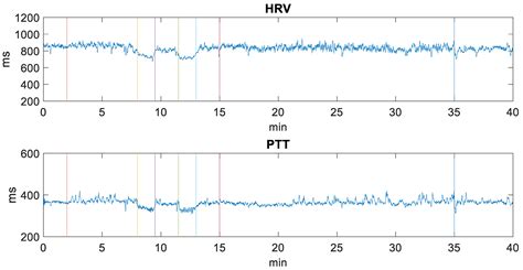 Wearable Epileptic Seizure Prediction System Based On Machine Learning Techniques Using Ecg Ppg