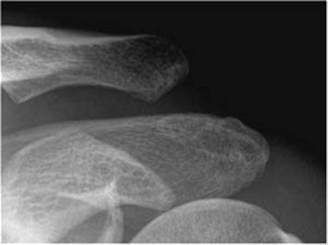 Musculoskeletal Joints And Tendons 61 Shoulder Case 6123