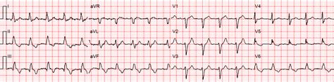 Svt With Aberrancy Acls Management