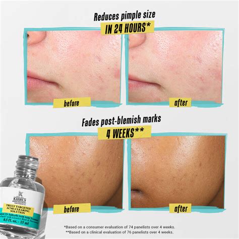 Truly Targeted Acne Clearing Solution — Pimple Patch — Kiehls