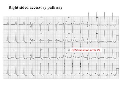 Ecg Localization Of Accessory Pathways Slideshare Pptx
