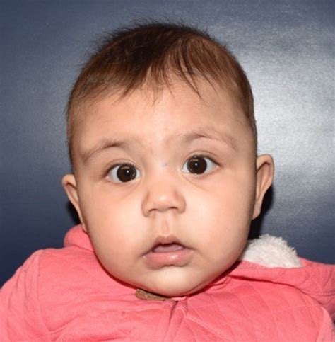 Craniosynostosis Before And After Photos By Rachel Ruotolo Md Garden