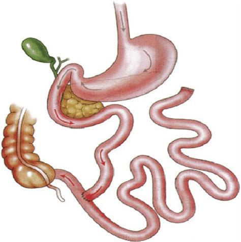 Traditional Jejunoileal Bypass Schematic Highlighting Bypassed Small