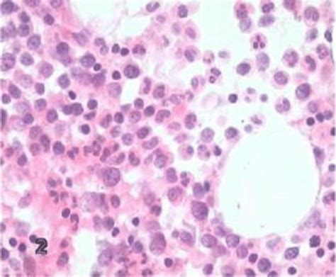 Bone Marrow Biopsy Showed No Evidence Of Leukemic Infiltration
