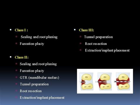 Furcation Involvement Treatment Of Furcationand Treatment Involved Teeth