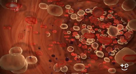 Leukemia Types Doctorpedia Doctor Reviewed Video