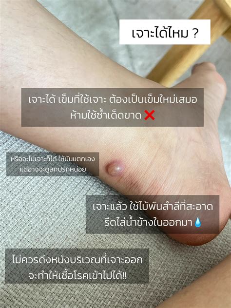 รองเท้ากัดจนพองเป็นตุ่มน้ำ จำเป็นต้องเจาะไหม แกลเลอรีที่โพสต์โดย Kkacha Lemon8