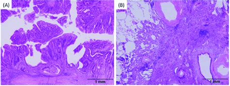 A Photomicrograph Of Carcinoma In Adenoma Of The Duodenum With