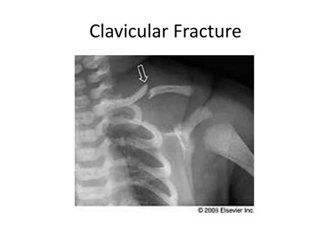 Clavicular Fracture Newborn Fracture Clavicule Nourrisson Sfspf